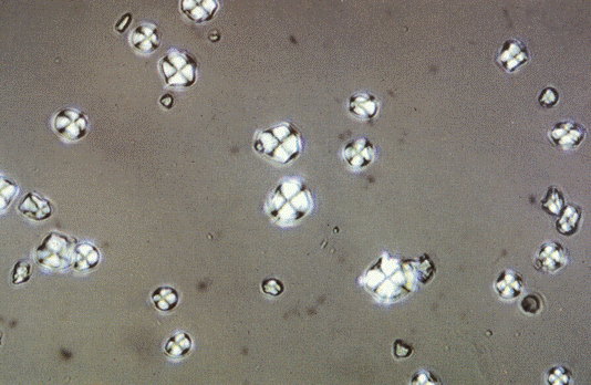 Urine Artifacts ~ Medical Labs Everyday Urine Artifacts ~ Medical Labs Everyday