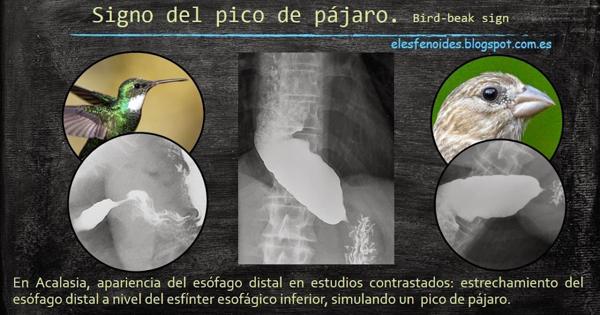 El esfenoides: Signo del pico de pájaro. Bird-beak sign.