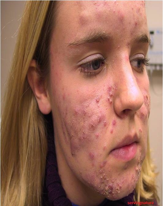 Huge Pimple Under Skin No Head A Pimple Free Face Rst Ebook200 huge-pimple-under-skin-no-head-a-pimple-free-face-rst-ebook200