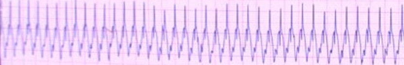 What Does A Moon Landing ECG Look Like what-does-a-moon-landing-ecg-look-like