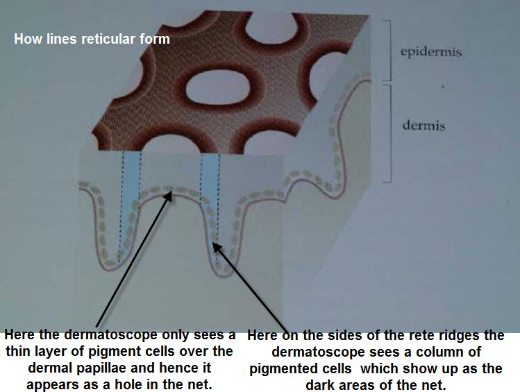Dermoscopy Made Simple: Dermatoscopic Structures - Histological Correlations- Hence DDs