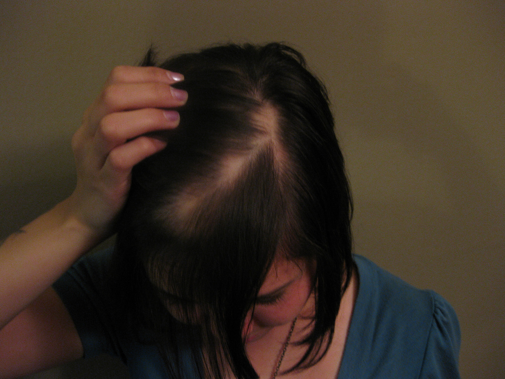 Medical Term For Hair Loss medical-term-for-hair-loss