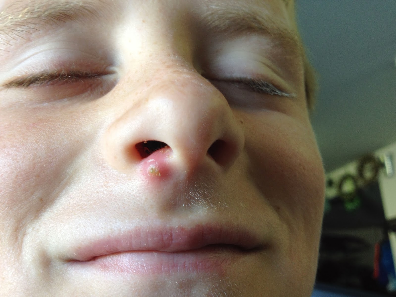 Potd 293 Giant Zit potd-293-giant-zit