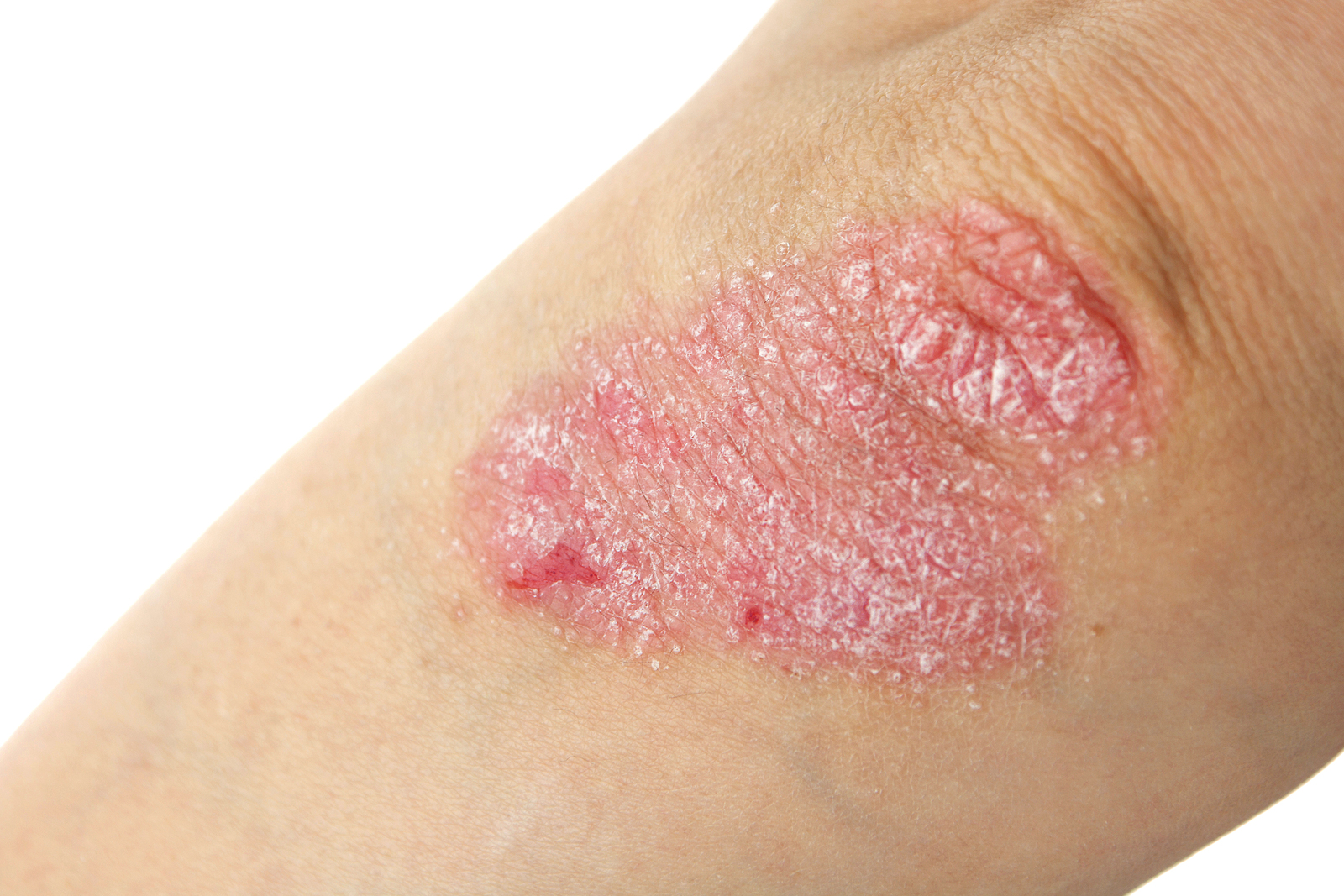 Como Se Cura La Psoriasis Tipos De Psoriasis Y Sus Tratamientos como-se-cura-la-psoriasis-tipos-de-psoriasis-y-sus-tratamientos