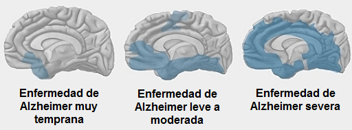 ALZHEIMER: Signos y síntomas en el desarrollo de la enfermedad ALZHEIMER: Signos y síntomas en el desarrollo de la enfermedad