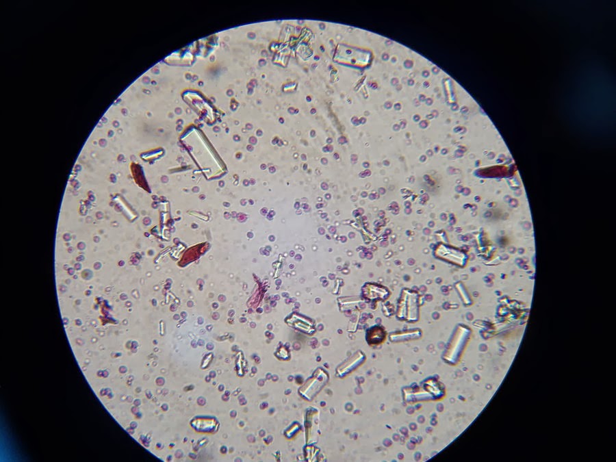 Urine Artifacts ~ Medical Labs Everyday Urine Artifacts ~ Medical Labs Everyday