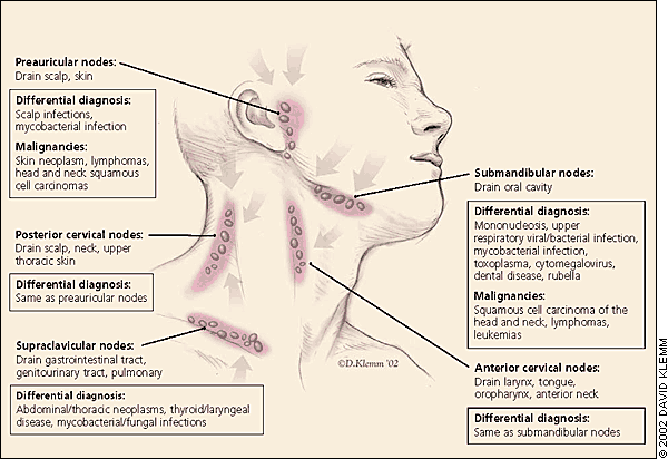 Supraclavicular lymph nodes swollen both sides - bikinifiko Supraclavicular lymph nodes swollen both sides - bikinifiko
