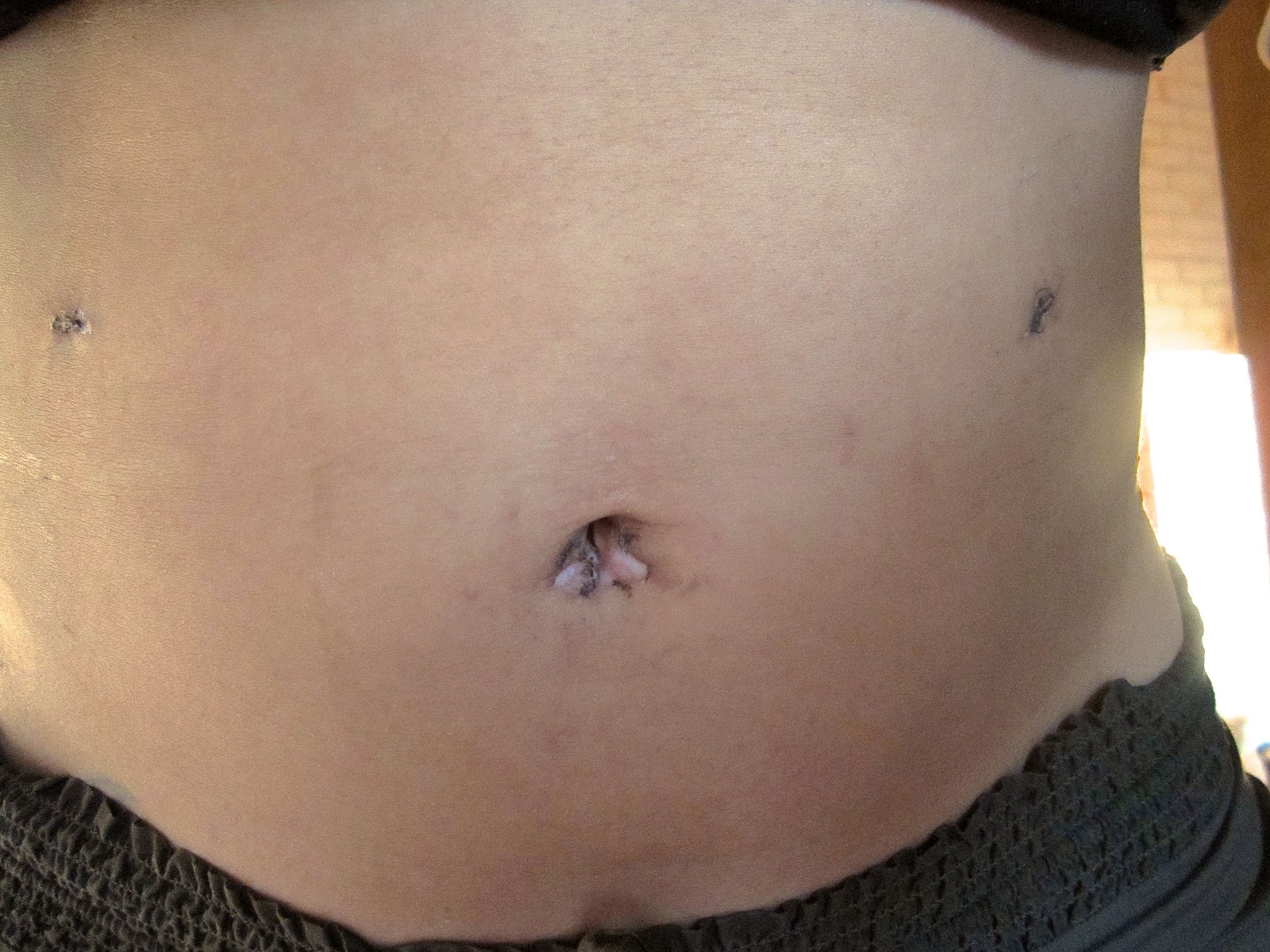 Fibroid Surgery Recovery Ruminations fibroid-surgery-recovery-ruminations