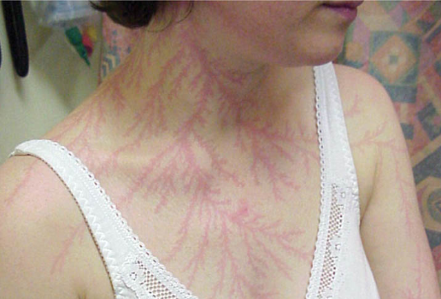 STUFF: Most Amazing thing 4: Lightning scars.