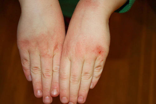 Consumer Health Answers Protect Your Skin In Winters consumer-health-answers-protect-your-skin-in-winters
