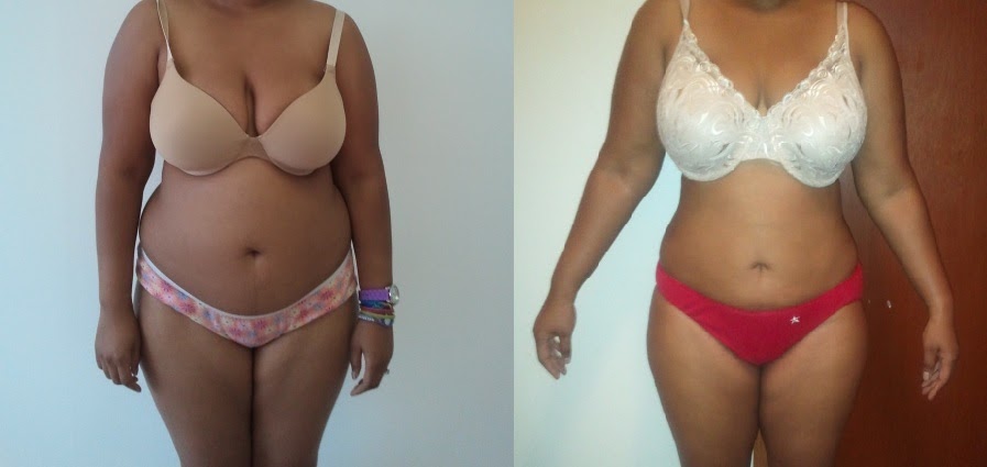 My Laser Lipo Journey American Lipo Centers 6 Weeks Later With PICTURES my-laser-lipo-journey-american-lipo-centers-6-weeks-later-with-pictures