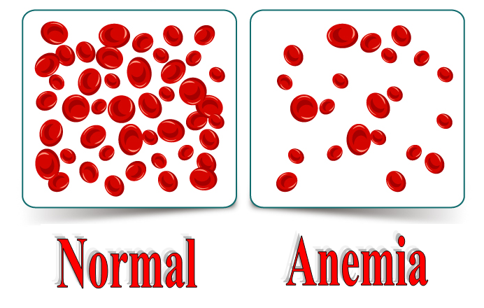Get to Know: What is Anemia – MedRition Get to Know: What is Anemia – MedRition