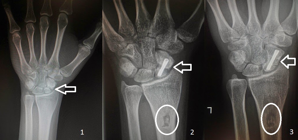 FisioBuendía: FRACTURA DE ESCAFOIDES CARPIANO FisioBuendía: FRACTURA DE ESCAFOIDES CARPIANO