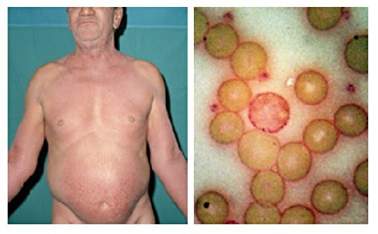 Cancer Centers Mantle Cell Lymphoma Prognosis Is There A New Cure cancer-centers-mantle-cell-lymphoma-prognosis-is-there-a-new-cure