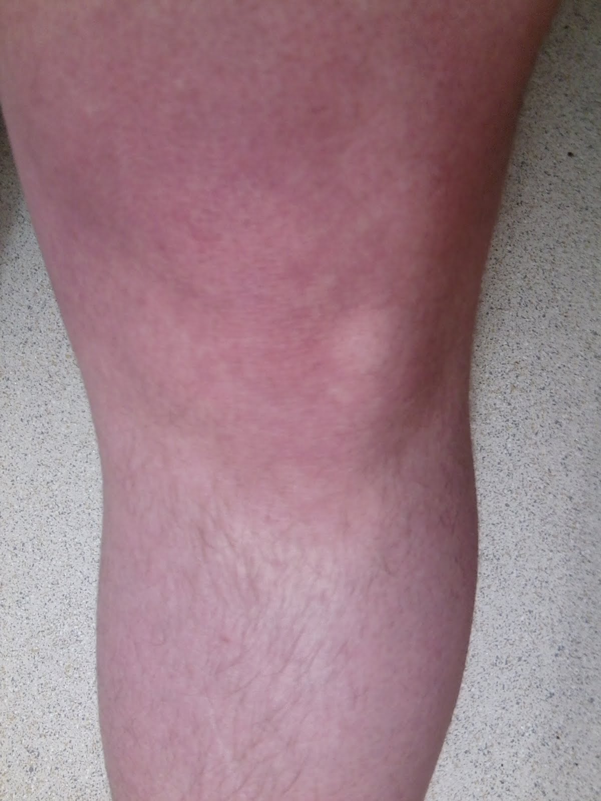 Skegnews Arthritis Or Bakers Cyst Swelling skegnews-arthritis-or-bakers-cyst-swelling