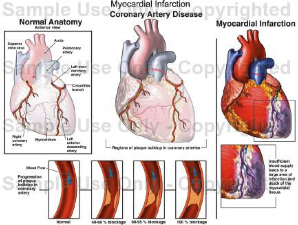 Carolcoxclassroom Heart Attack Health NEMO Early Heart Attack Care carolcoxclassroom-heart-attack-health-nemo-early-heart-attack-care
