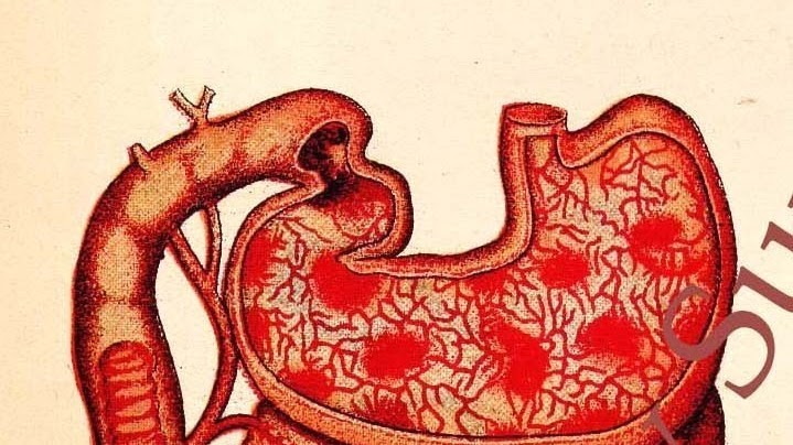 Gastritis - Effects Of Alcohol On The Stomach - Effect Information Center