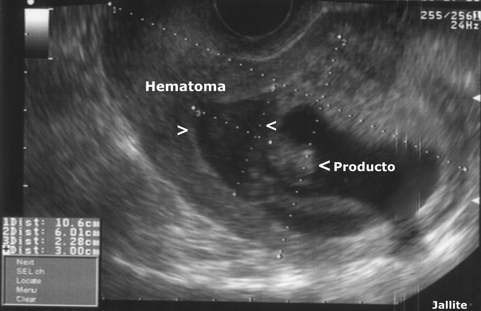 HEMATOMA SUBCORIONICO EN EL EMBARAZO CONSECUENCIAS - Wroc?awski ... HEMATOMA SUBCORIONICO EN EL EMBARAZO CONSECUENCIAS - Wroc?awski ...