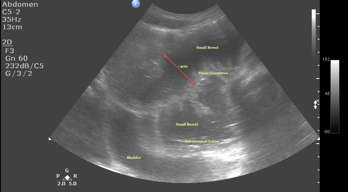 Small Bowel Obstruction Ultrasound Cases Info small-bowel-obstruction-ultrasound-cases-info