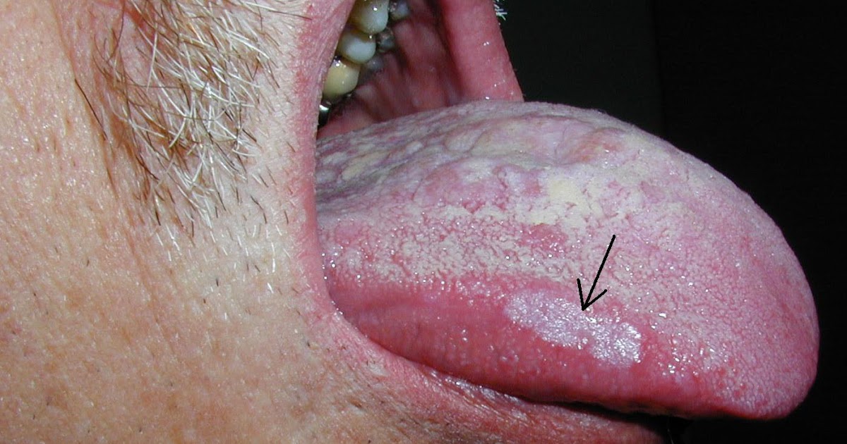 Health Teller White Spots On Mouth Mucosa health-teller-white-spots-on-mouth-mucosa