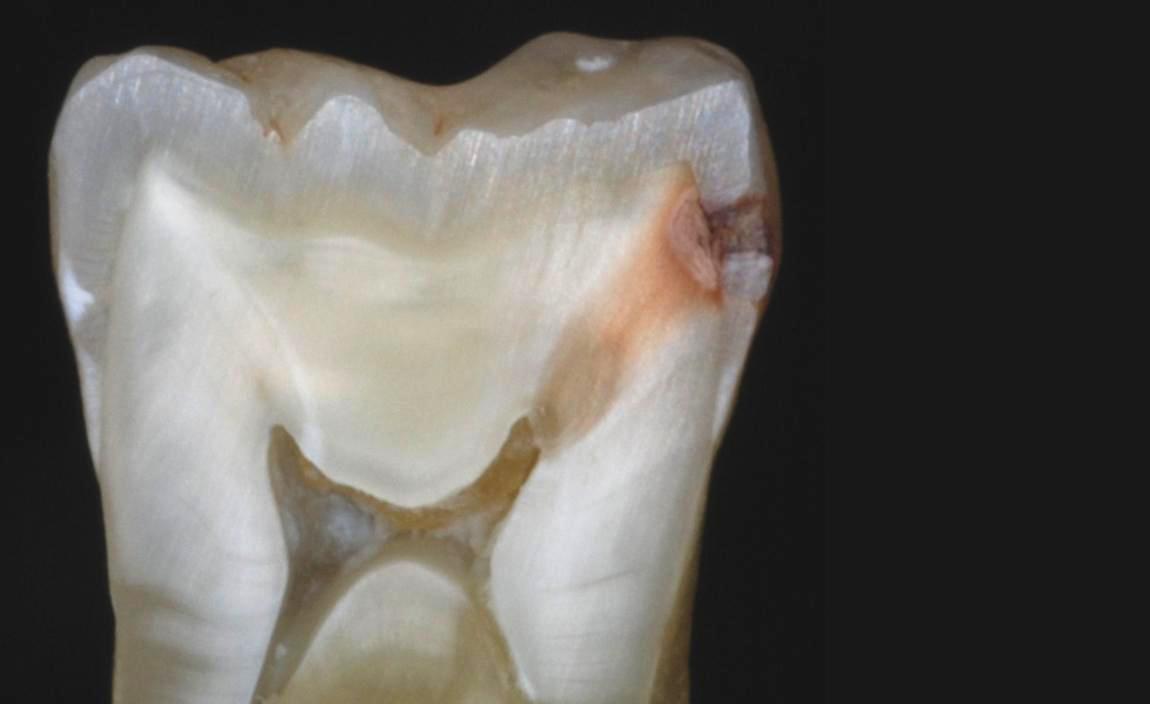Factores que dañan a la pulpa dental Factores que dañan a la pulpa dental