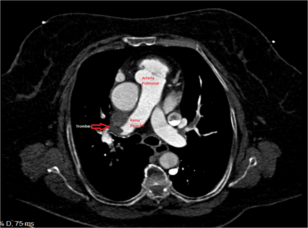 Centro de Salud Profesor Jesús Marín: Sesión clínica: Dímero D y TEP (tromboembolismo pulmonar)