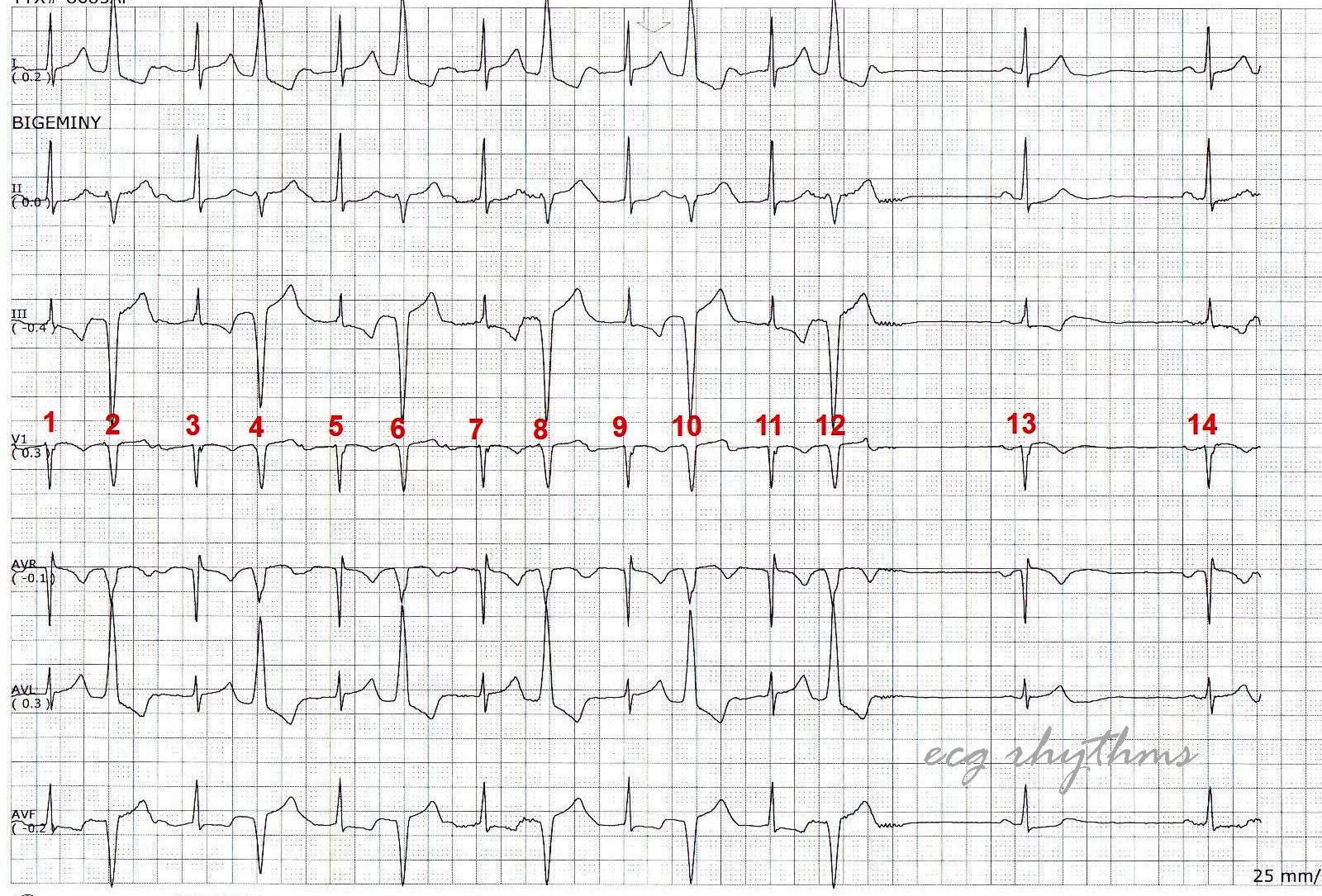 ECG Rhythms Concealed Conduction Affecting The AV Conduction ecg-rhythms-concealed-conduction-affecting-the-av-conduction