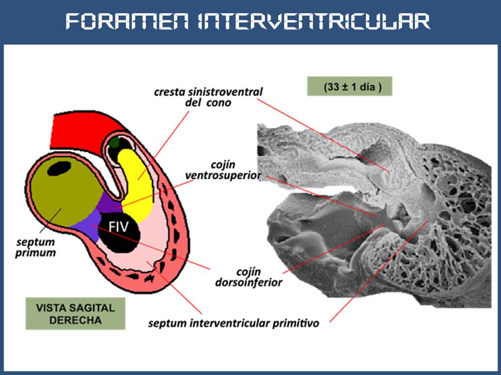 SOS EMBRIOLOGIA HUMANA: Foramen interventricular