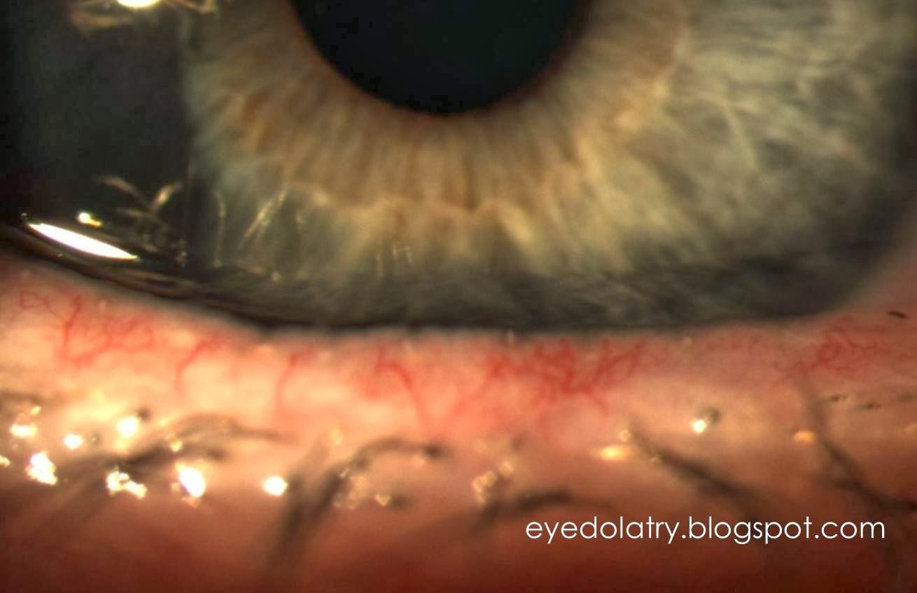 Dry Eye Syndrome A Photographic Review Eyedolatry dry-eye-syndrome-a-photographic-review-eyedolatry