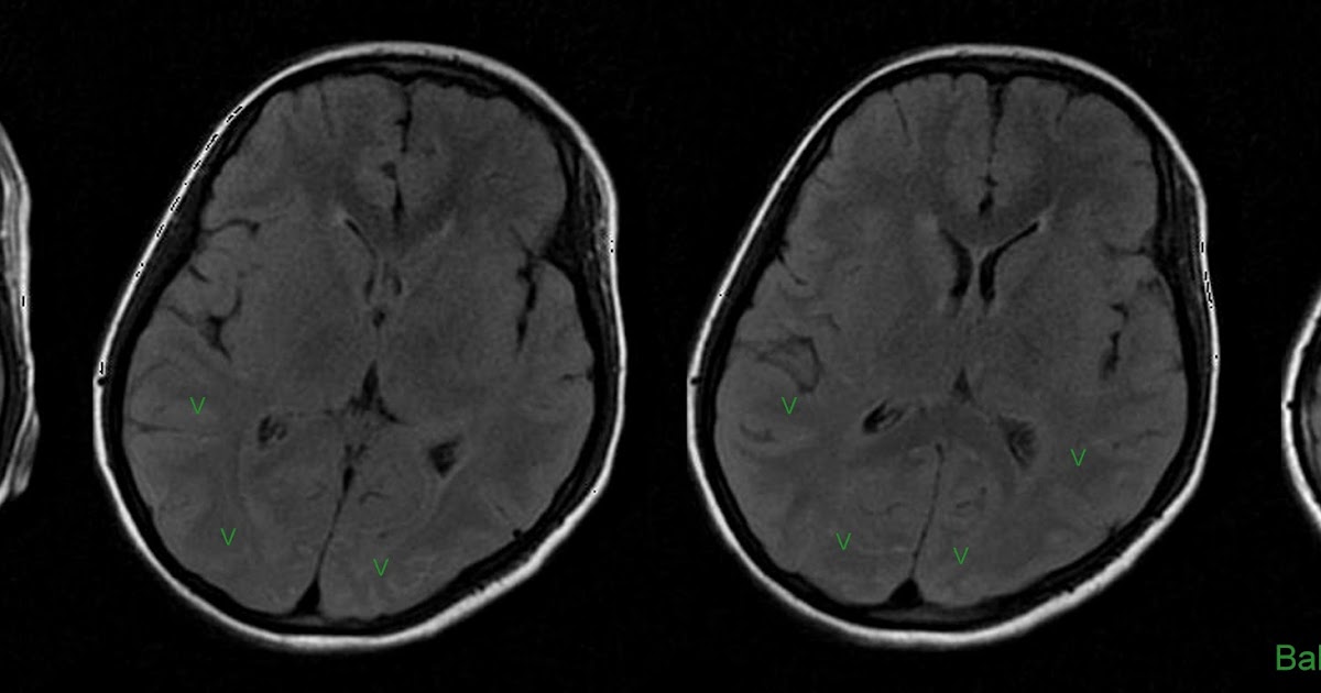 Neuroradiology Cases: Sulcal hyperintensity on FLAIR
