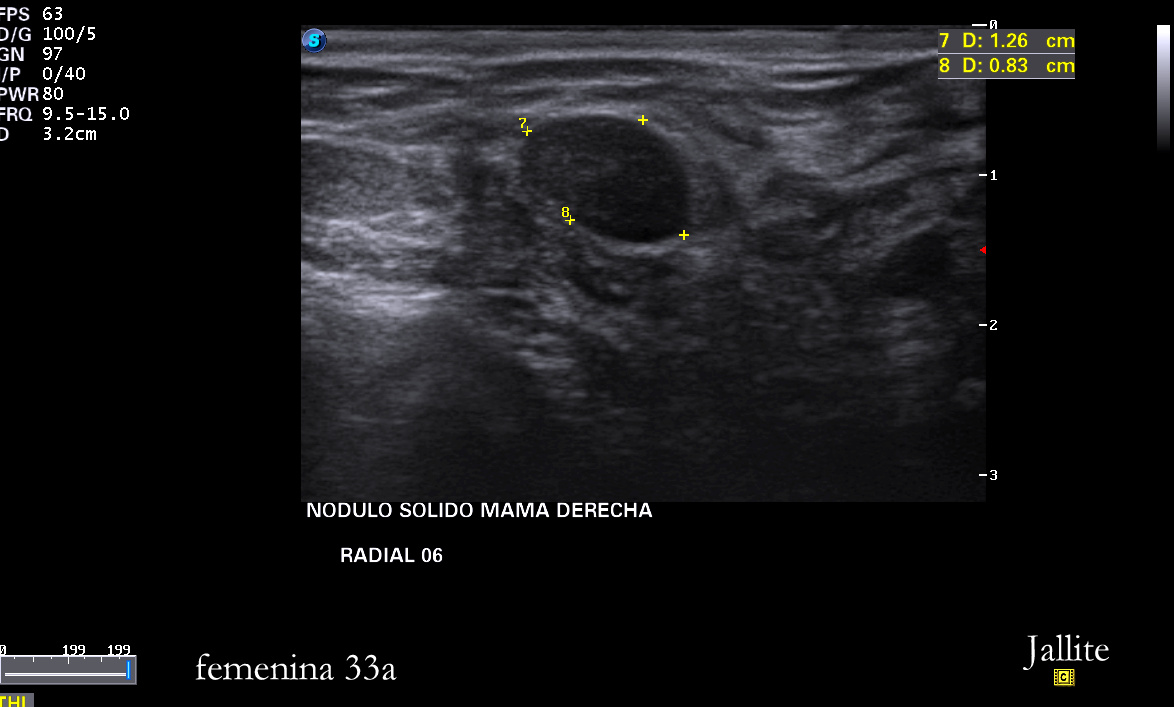 Nódulo Sólido Na Mama é Perigoso - RETOEDU