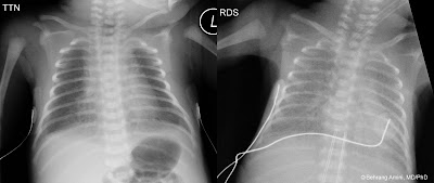 Roentgen Ray Reader: Neonatal Chest