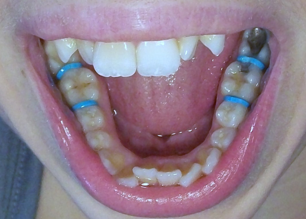 Do All Braces Have Molar Bands at Joseph Florence blog