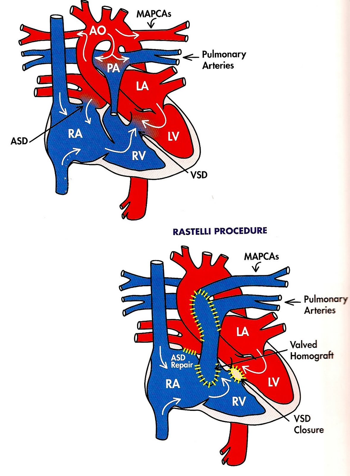 Pulmonary Atresia