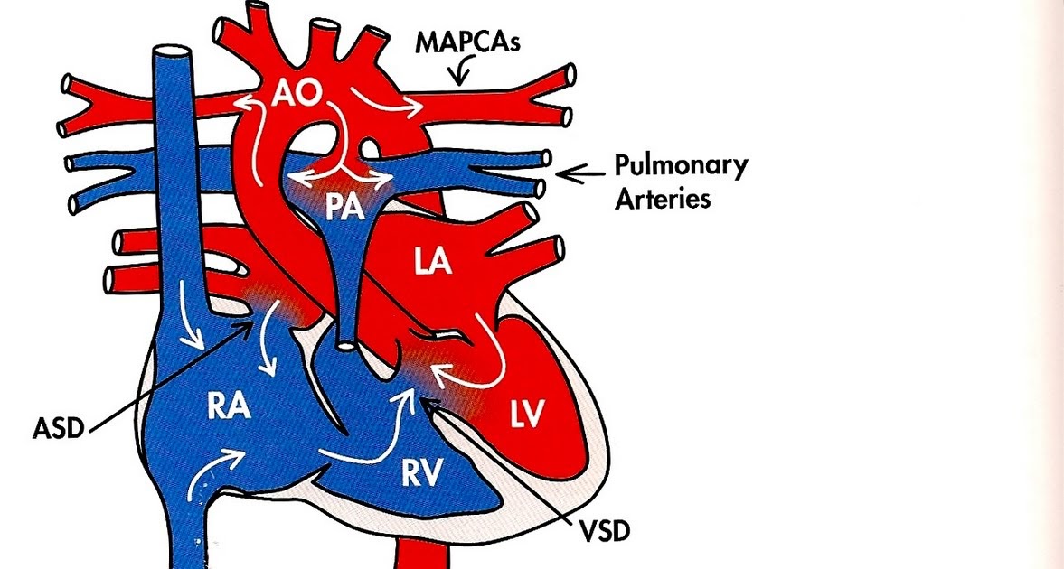 Heart defects, for everyone: Pulmonary Atresia with Major Aortopulmonary Collateral Arteries ...