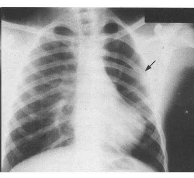 de duas costelas esquerda,