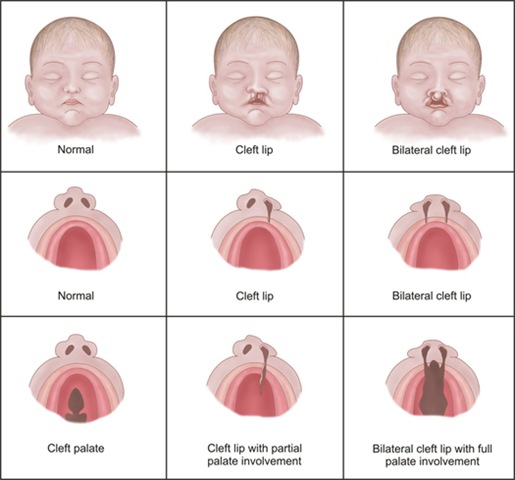 Cleft Palate