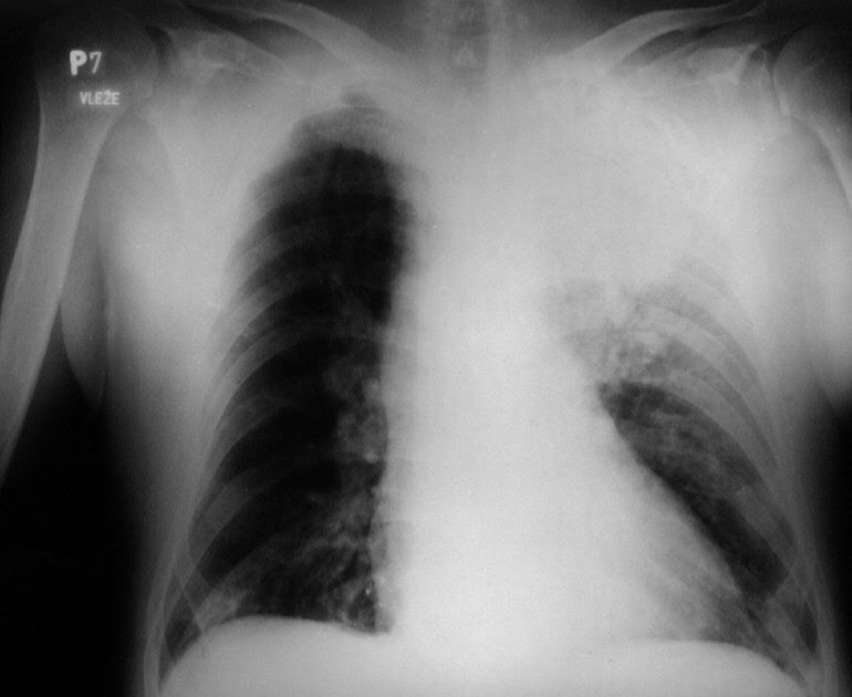 MBBS Medicine (Humanity First): Pneumonia MBBS Medicine (Humanity First): Pneumonia