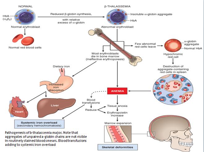 MBBS Medicine (Humanity First): Thalassemia. MBBS Medicine (Humanity First): Thalassemia.