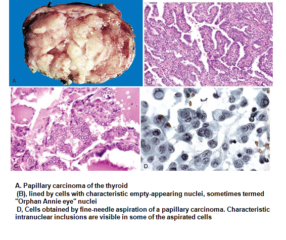 MBBS Medicine (Humanity First): Papillary Carcinoma. MBBS Medicine (Humanity First): Papillary Carcinoma.