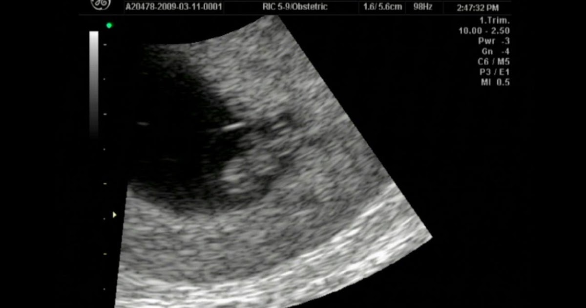 Pregnancy After Miscarriage Ultrasound 7 Weeks 6 Days pregnancy-after-miscarriage-ultrasound-7-weeks-6-days