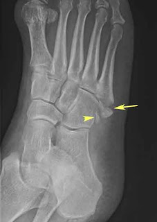 RiT radiology: Avulsion Fracture of Base of 5th Metatarsal & Os Peroneum