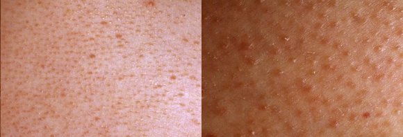 Do You Have Small Red Bumps On Your Upper Arms Memorable Days Beauty Blog Korean Beauty do-you-have-small-red-bumps-on-your-upper-arms-memorable-days-beauty-blog-korean-beauty