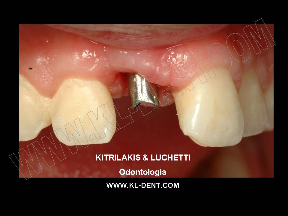 Kitrilakis & Luchetti - Dentistry: Dental Implant in Upper Central ... Kitrilakis & Luchetti - Dentistry: Dental Implant in Upper Central ...
