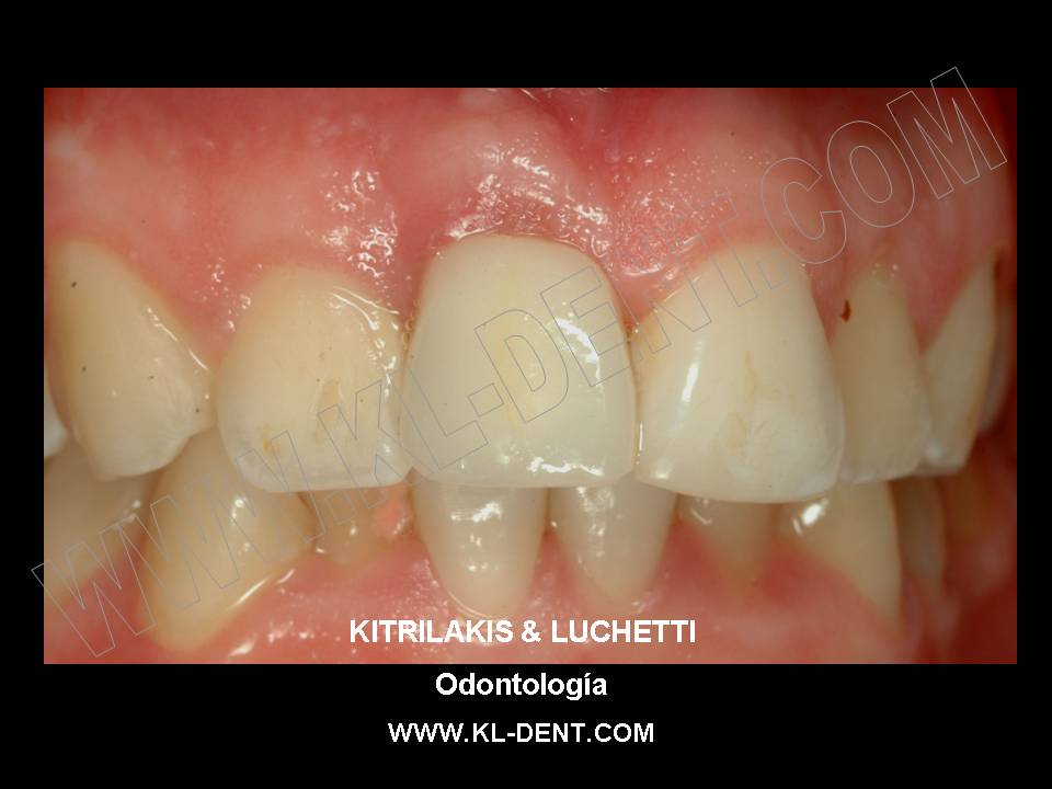 Kitrilakis & Luchetti - Dentistry: Dental Implant in Upper Central ... Kitrilakis & Luchetti - Dentistry: Dental Implant in Upper Central ...