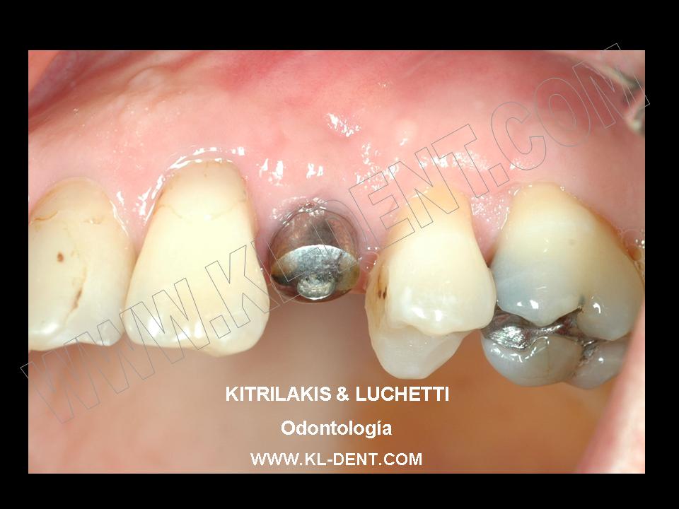 Kitrilakis & Luchetti - Dentistry: Dental Implant in Upper Premolar: Case 1 Kitrilakis & Luchetti - Dentistry: Dental Implant in Upper Premolar: Case 1