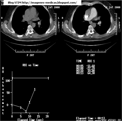 Sobre técnicas de imágenes médicas (Blog STIM): Tromboembolismo Pulmonar (TEP) y Tc multicorte ...