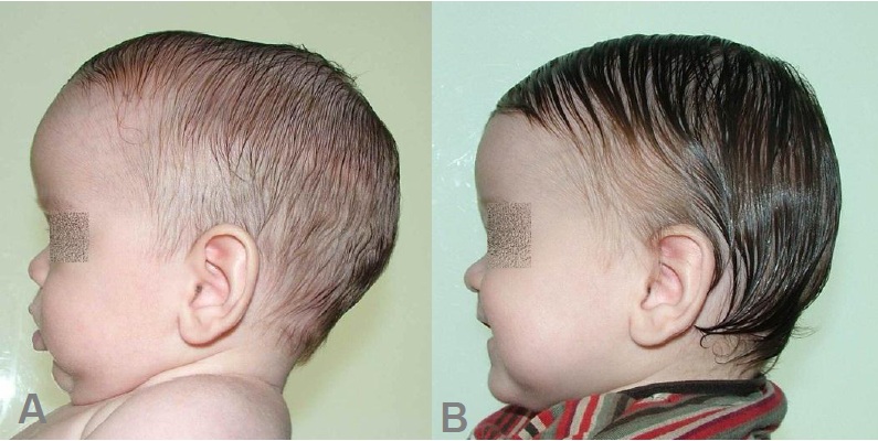 neuropedi: craneosinostosis en el RN