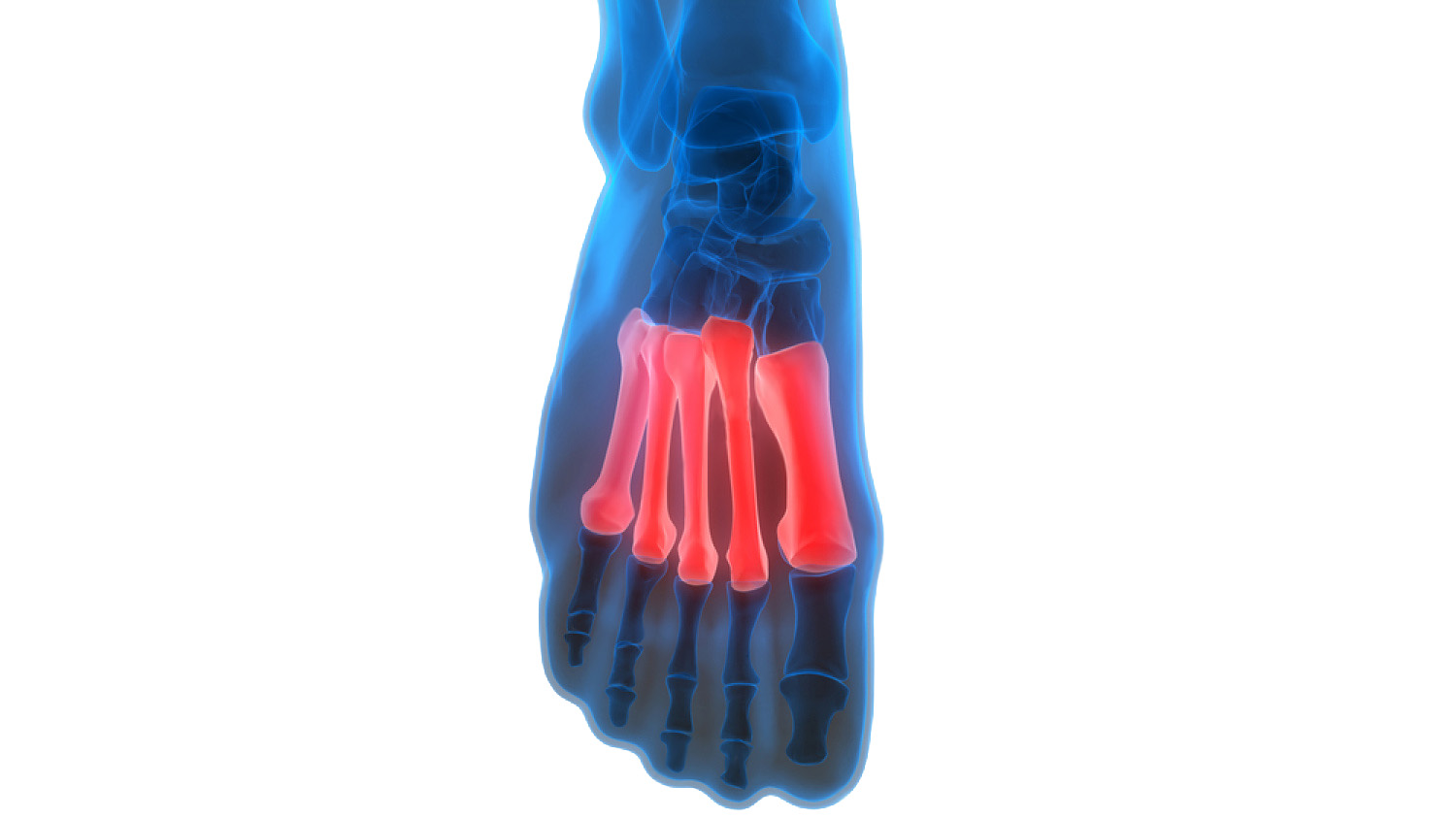 Foot Pain & Interdigital Neuritis: Science Based