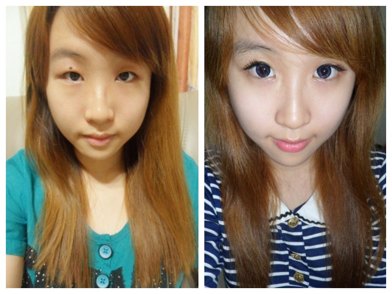 World Of Hairstyle My Double Eyelid Surgery Before And After